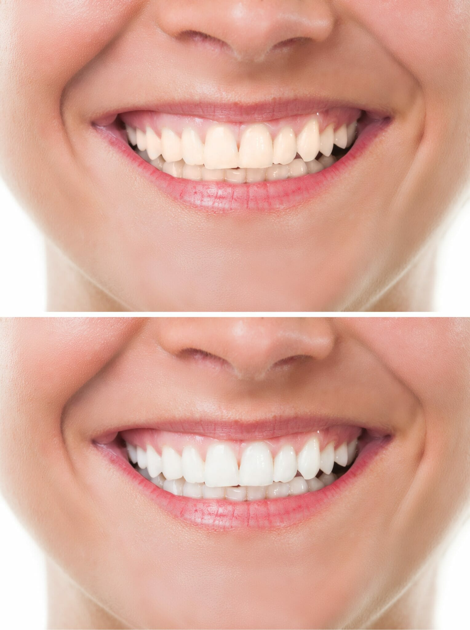 Can Complete Dentures Look Good? By Dr. Kyle Hornby, Kitchener Dentist