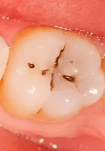 Kid's Dentistry Corner: What do Cavities Look Like? - Dr. Kyle Hornby